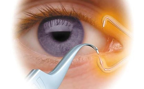 Plug Lacrimal Para O Tratamento Do Olho Seco - Oftalmologia